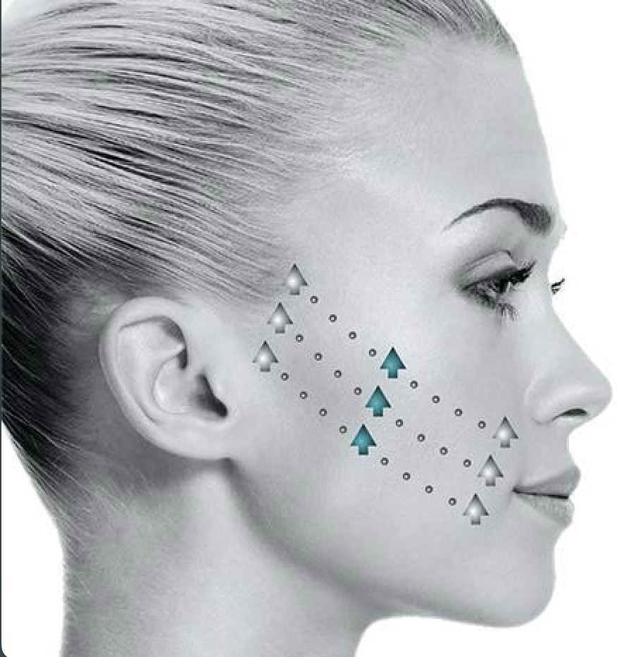 Thread lift Silhouette - SHABNAM MEDICAL AESTHETIC