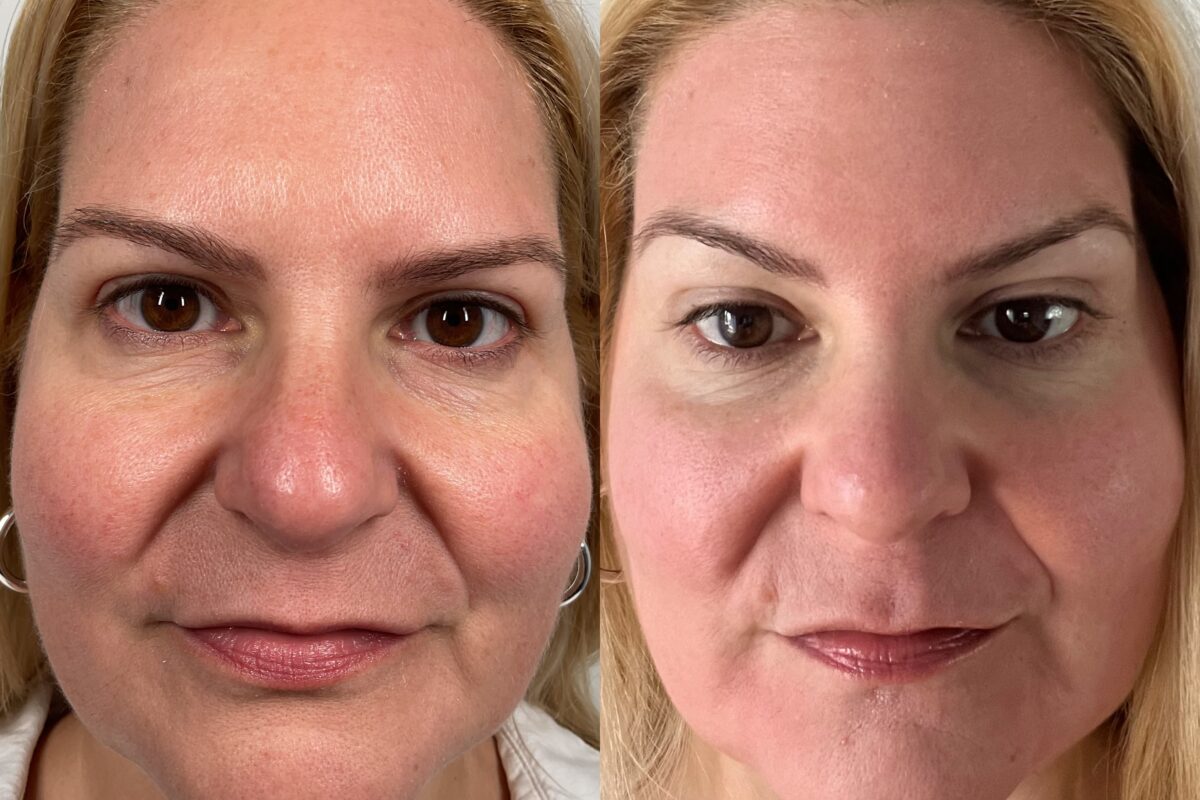 Fraxel Laser Treatment in Laval & Montreal | Facial Rejuvenation